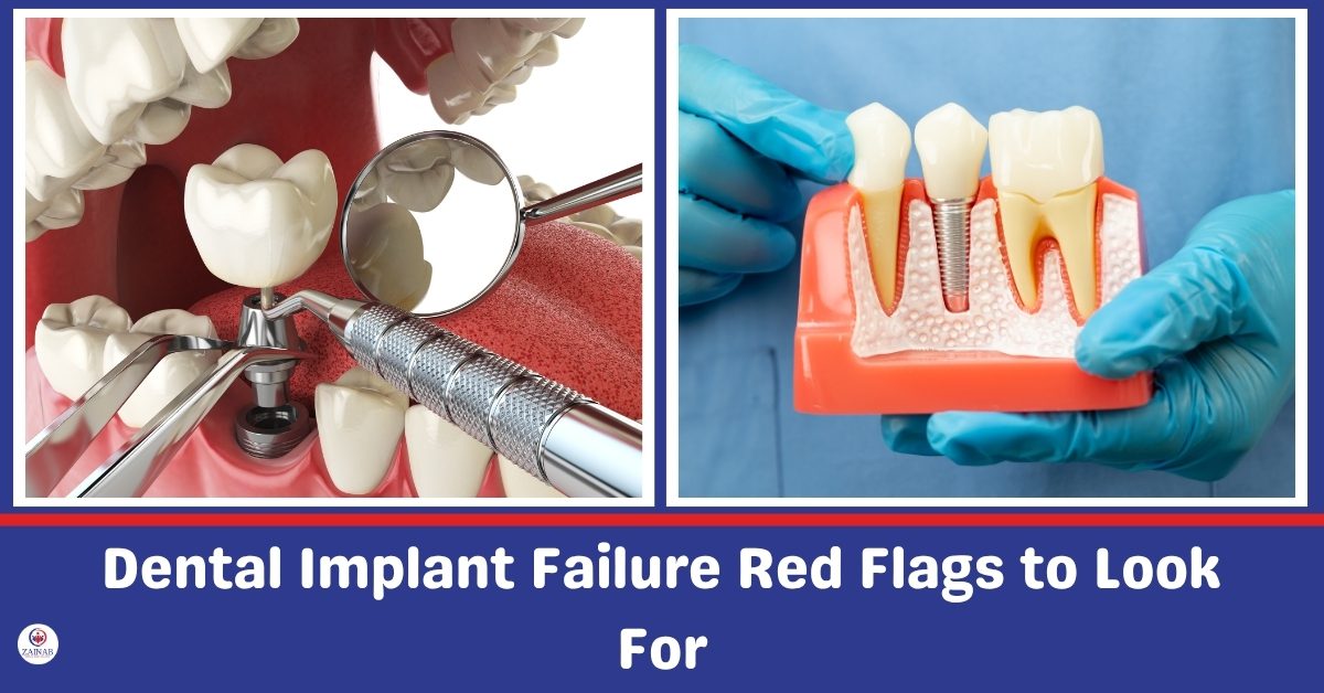 Dental Implant Failure Red Flags to Look For