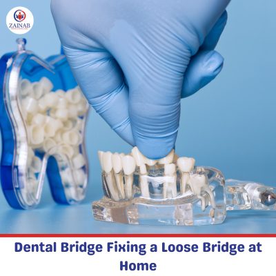 Dental Bridge Fixing a Loose Bridge at Home