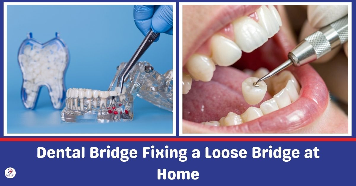 Dental Bridge Fixing a Loose Bridge at Home